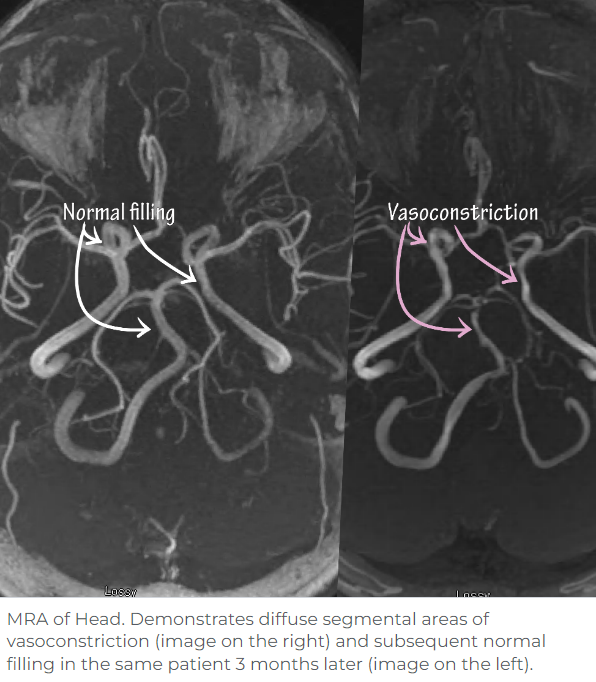 Reversible cerebral vasoconstriction syndrome(가역성 뇌혈관수축증후군, RCVS) : 네이버 블로그