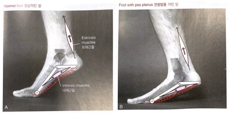 Windlass Mechanism, 권양기 효과 : 네이버 블로그
