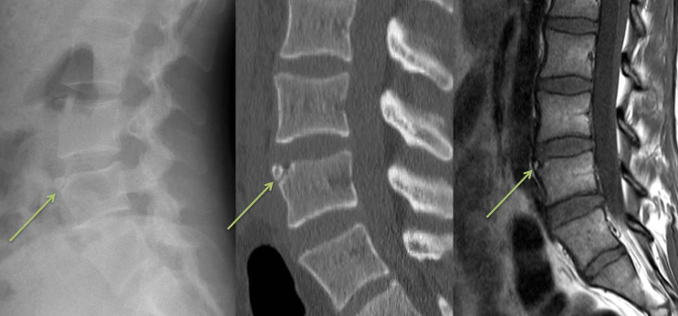 Limbus Vertebra (변연 척추) : 네이버 블로그