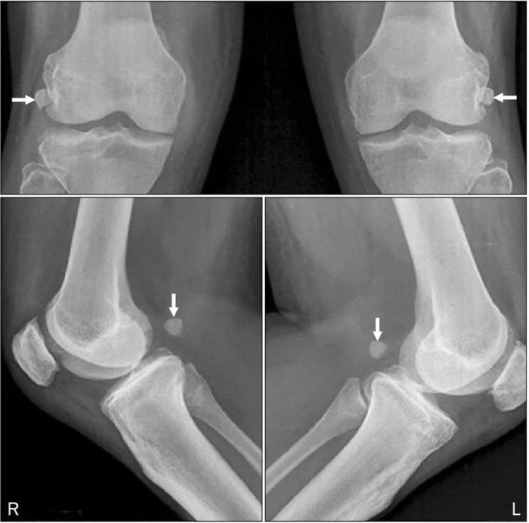 Fabella bone : 네이버 블로그