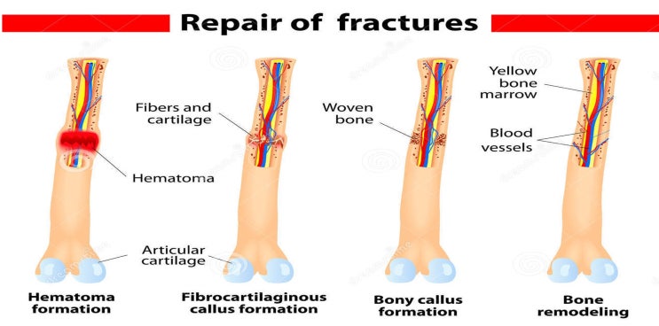 Osteoblast(조골세포) and Osteoclast(파골세포) : 골치유과정(Bone healing process ...