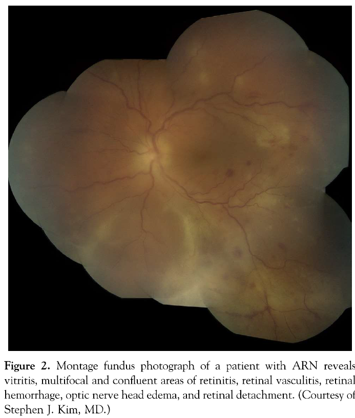 ARN (Acute retinal necrosis) : 네이버 블로그