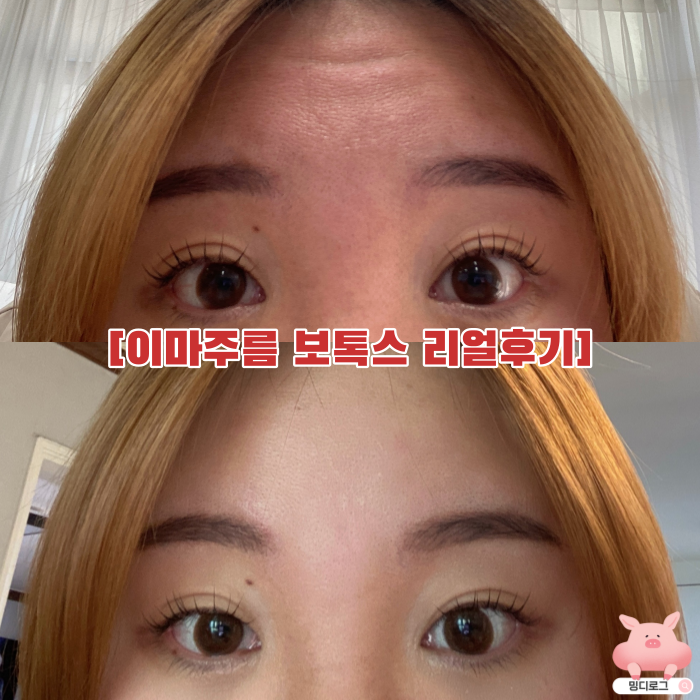 이마주름 보톡스 3회차 시술 내돈내산 리얼 후기효과 부작용 유지기간 네이버 블로그