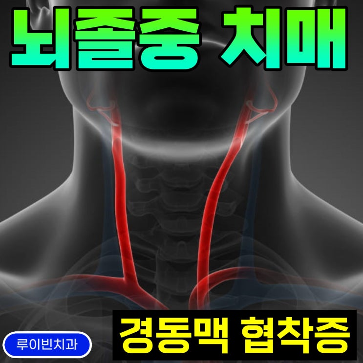 경동맥 협착증혈전 막힘 증상 원인치료 병원 네이버 블로그