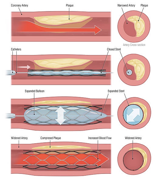 CAG(관상동맥조영술, Coronary Angiography), PCI(경피적관상동맥중재술, Percutaneous ...