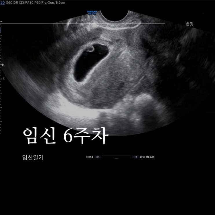 임신6주차 두번째 초음파 심장소리 난황 입덧약 아미렉틴 조리원 상담 네이버 블로그