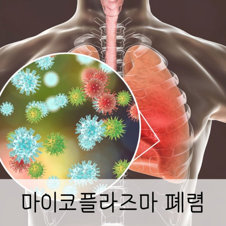 둘째 조산하게 했던 마이코플라즈마 폐렴 증상f중국폐렴확산 연중발생하던 세균성폐렴 네이버 블로그