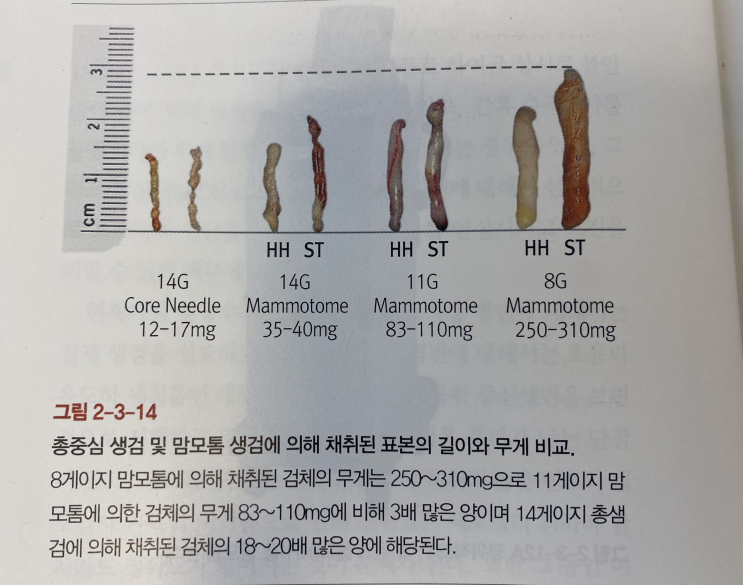 유방의 조직검사 #2 - 진공보조생검(VABB,Mammotome™) : 네이버 블로그