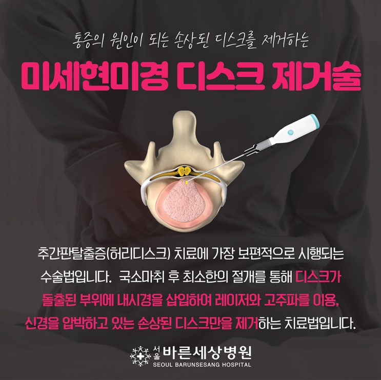 질환 추간판탈출증허리디스크 치료에 시행되는 미세현미경 디스크 제거술 네이버 블로그