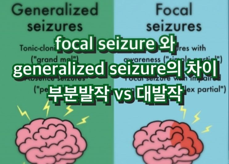 focal seizure vs generalized seizure차이 : 네이버 블로그