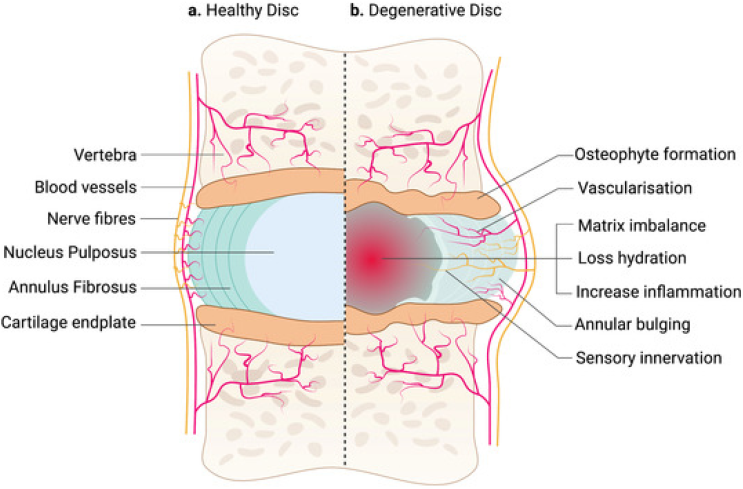 디스크성 요통과 디스크 내장증 Discogenic pain and Internal Disc Disruption (1) : 네이버 블로그