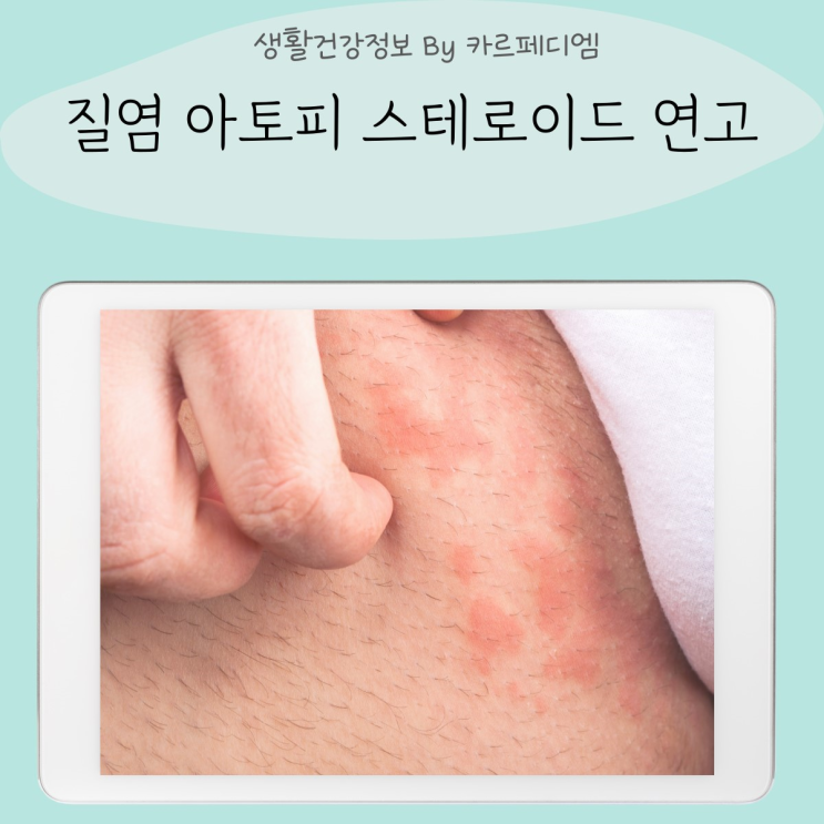 겐트리손크림 세레스톤지 티티베연고 질염 아토피피부염 스테로이드 연고 효능 부작용 사용법 가격 처방 약국 네이버 블로그