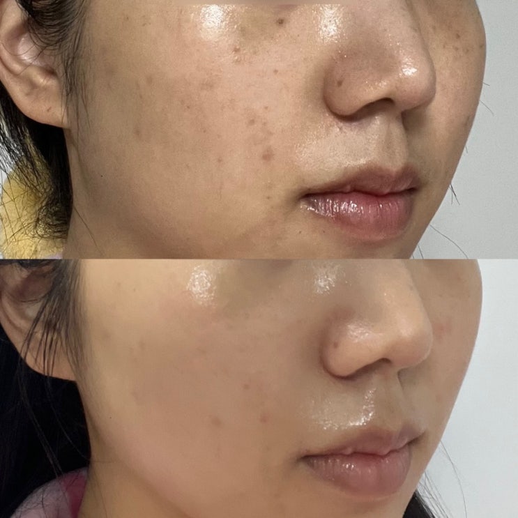 논현역 피부과프리미엄 색소 레이저 색소침착 기미 제거 한 번에 네이버 블로그
