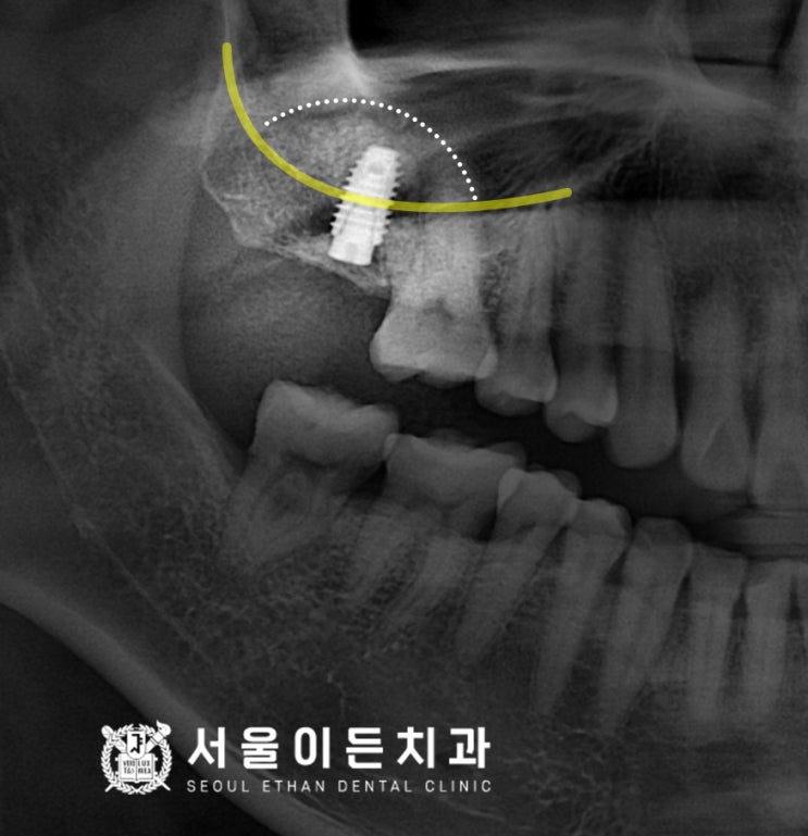 불광동 치과 추천 상악동 거상술 을 동반한 고난도 임플란트 식립 과정 네이버 블로그