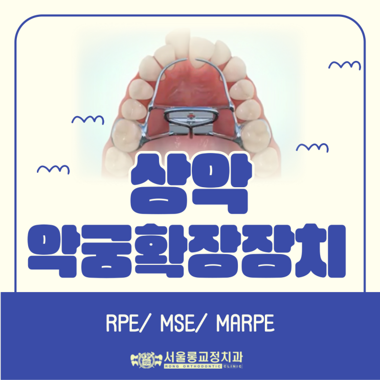 [개롱역 치과] 상악악궁확장 장치란 ? (RPE/ MSE / MARPE) : 네이버 블로그