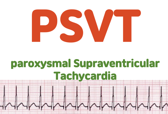 부정맥 (I47발작성빈맥 I48심방세동 및 조동 I49기타심장부정맥)중 I47 발작성빈맥 : 네이버 블로그