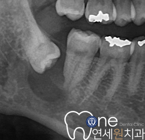 동탄 치과 염증으로 인한 골소실 뼈이식 후 임플란트 식립 케이스 네이버 블로그