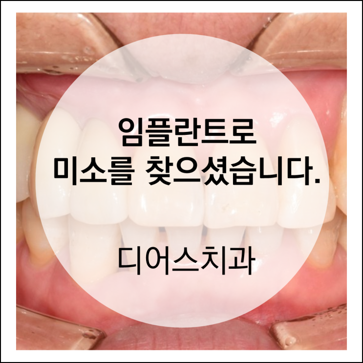대학병원 권유받았는데 임플란트 되나요 임플란트 뼈 이식 수술 치조골 이식술 강동구 천호동 암사동 임플란트 치과