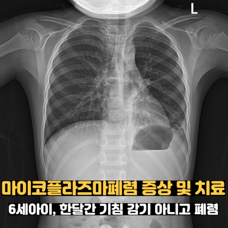 6세아이 중국폐렴 마이코플라즈마폐렴 증상 진단 치료까지 네이버 블로그