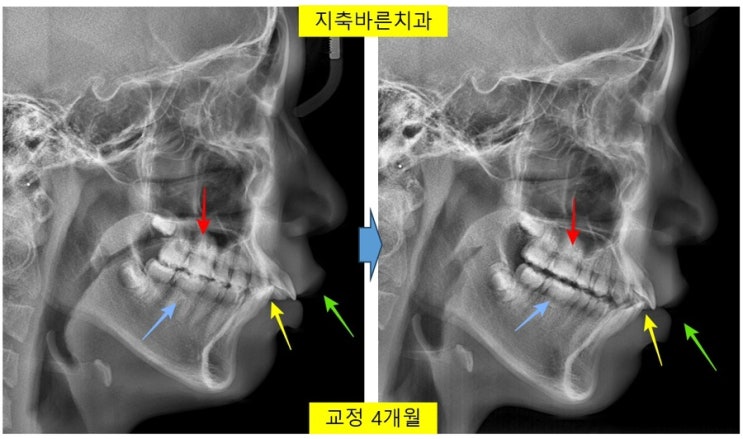 앞니 뻐드러짐 아래턱 작음 성장기교정 성장판검사 지축치과 지축역치과 삼송치과 삼송교정 원흥치과 원당치과 화정치과파주치과 양주