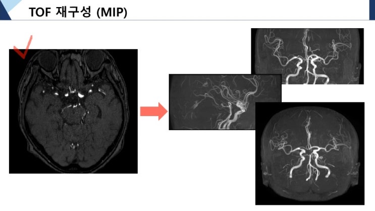 MRI 공부 - MRA 1. TOF(time of flight) : 네이버 블로그