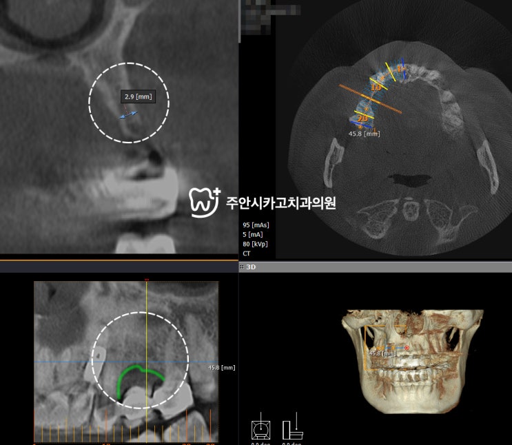 주안동 치과 잘하는곳 오래된 브릿지 제거 후 임플란트 뼈가 얇아도 할 수 있을까 릿지 스플릿 Ridge Split 활용