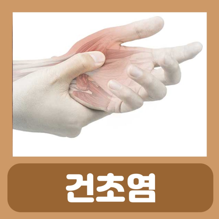 드퀘르벵보호대 손목 건초염 수술 치료 왼쪽 손목 저림 엄지 손가락 통증 염증 손저림 네이버 블로그