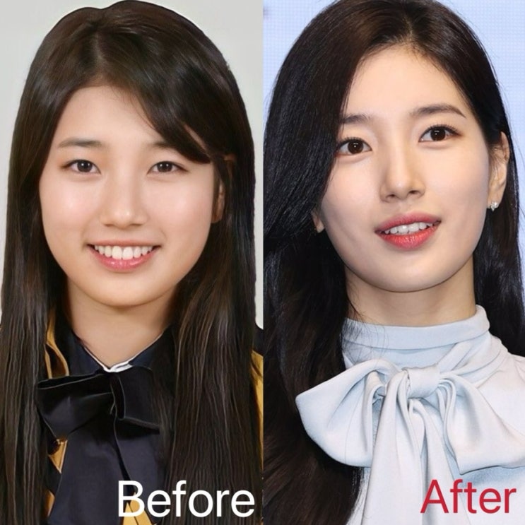 여자 헤어라인왁싱 전후 모음 선미 윤아 수지 헤어라인 교정 제모 변화 네이버 블로그