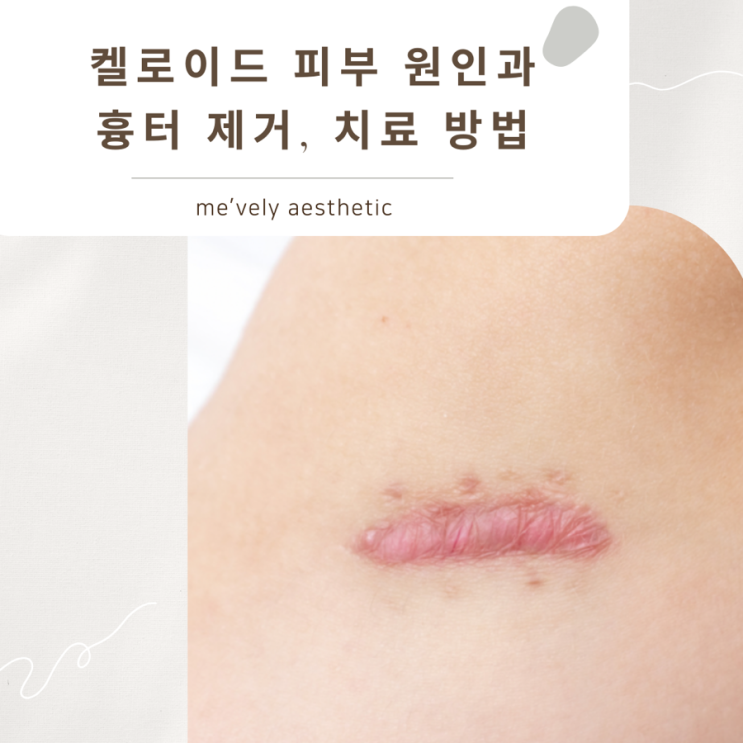 켈로이드 피부 원인과 흉터 제거 치료 방법 네이버 블로그