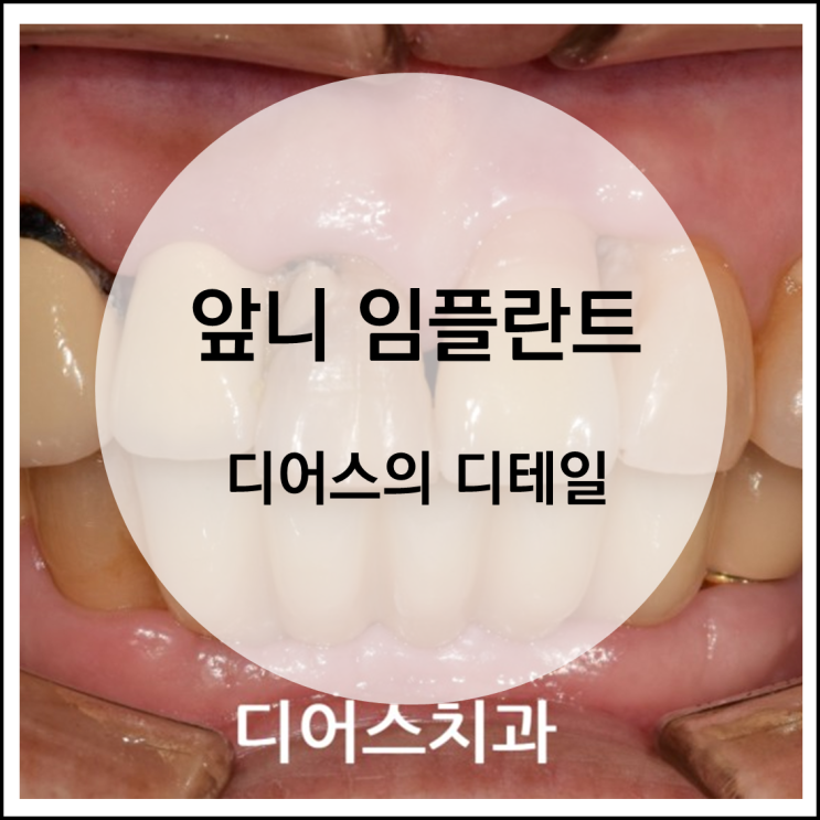 80대 아래 앞니 임플란트 브릿지 앞니뼈이식 하악 골 융기 제거 명일역 고덕역 치과 네이버 블로그