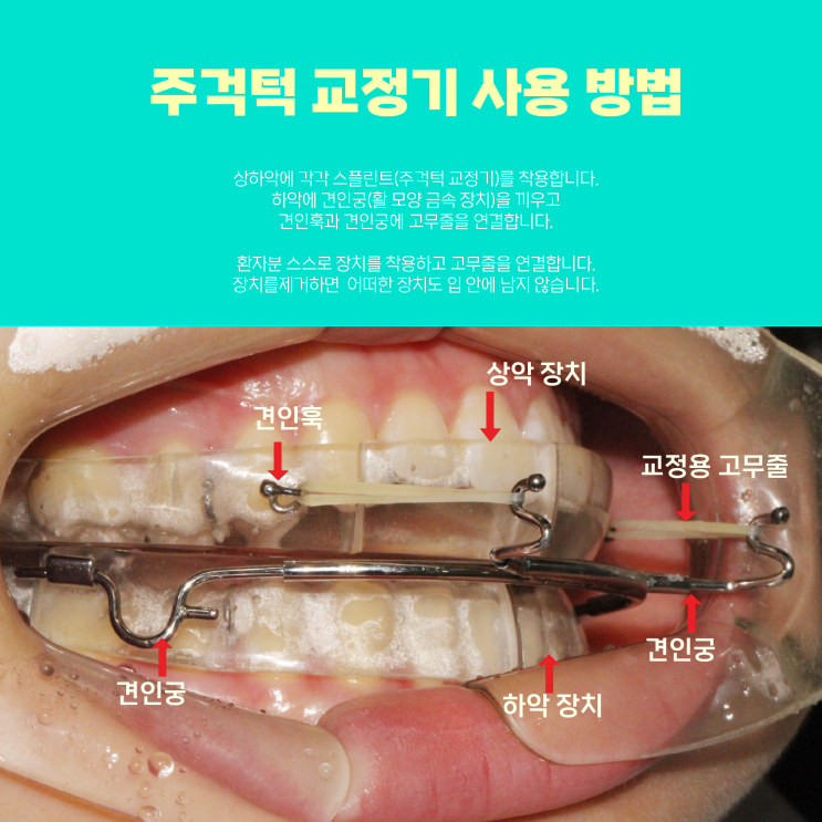 주걱턱 교정기 TTBA 선택했다면 : 네이버 블로그