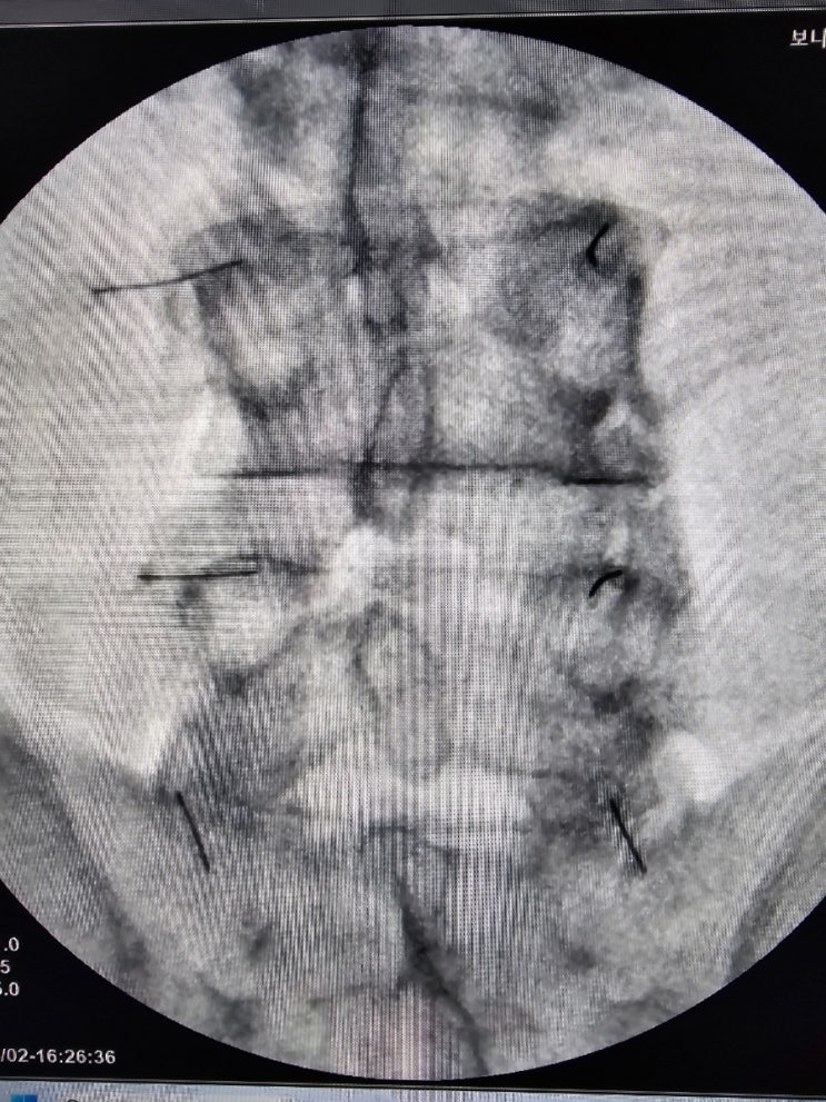 both L3,4,5 MBB medial branch block #허리통증주사 #허리통증 : 네이버 블로그