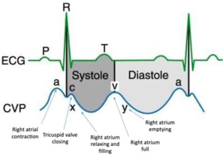 A-line, EKG 리듬, 중심정맥압, 폐동맥압 Waveform 총 정리 : 네이버 블로그