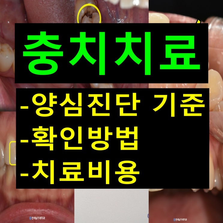 충치초기치료비용 종류단계확인인레이신경치료비용 충치치료 안하면 되는경우강동구양심치과 네이버 블로그
