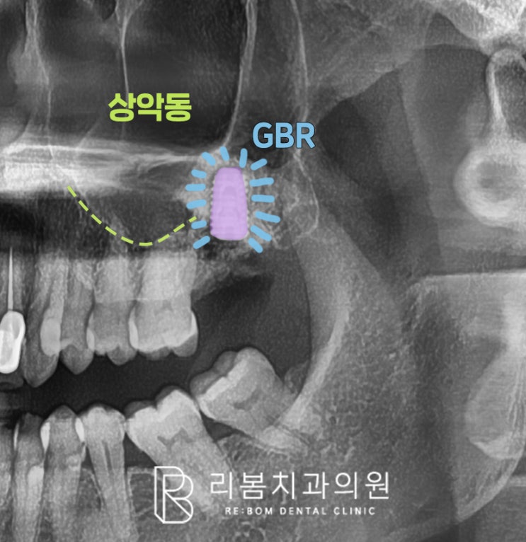 "상악동 거상술 수직 접근법(sinus crestal approach case)" 과도한 치조골 소실 어금니 발치 후 임플란트 ...