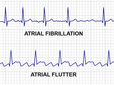 EKG & 부정맥 : 네이버 블로그