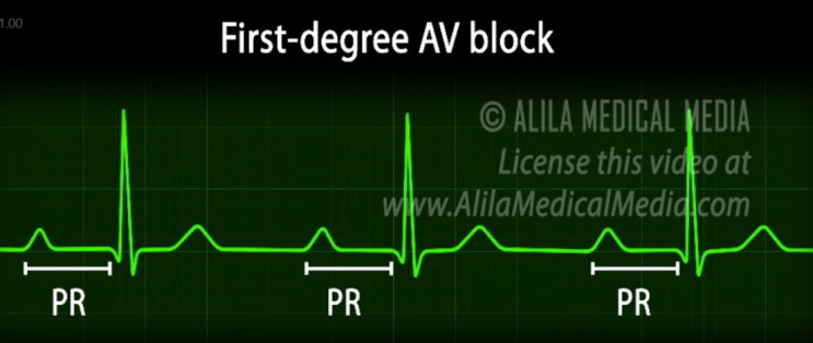 중환자실 AV block(방실차단) 개념 공부하기 / 심장 전도계 / 1도 방실차단 / Mobitz(모비츠) 1형, 2형 / 3 ...