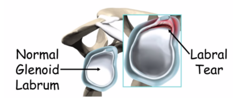 Labral Tears (SLAP lesions) 어깨관절의 이학적검사 shoulder special test : 네이버 블로그