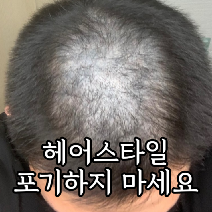 인천탈모펌 인천맨즈헤어 주안동바버샵 정수리 머리숱 없는 남자 고민해결 포기하지 마세요 네이버 블로그