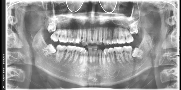 [교정과] 치아이동에 의해 스크류에 치근이 닿으면 어떻게 될까? 그 답을 찾다. (screw & root contact ...