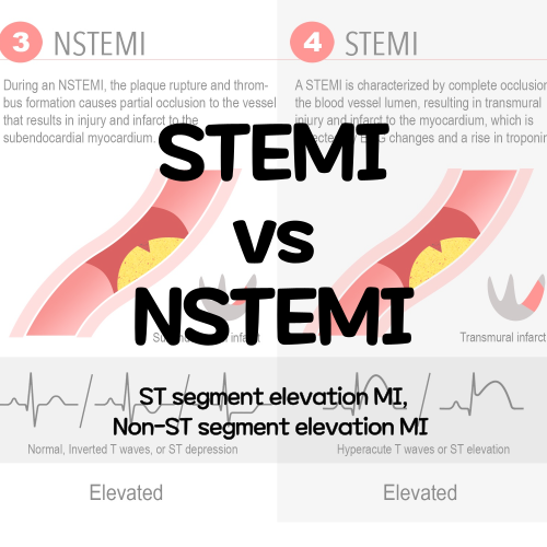 STEMI와 NSTEMI (심근경색, myocardial infarction) : 네이버 블로그