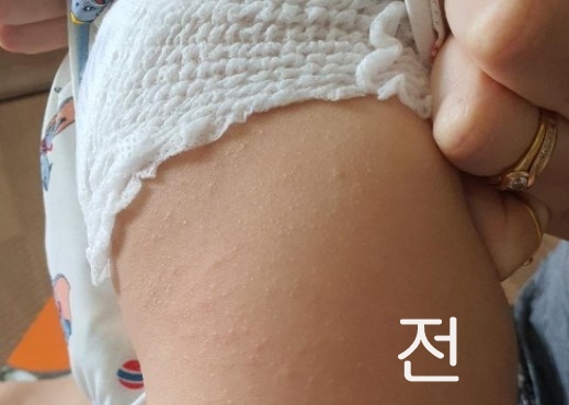 다리가려움 모공각화증 2주만에 좋아진 후기전후 사진 네이버 블로그