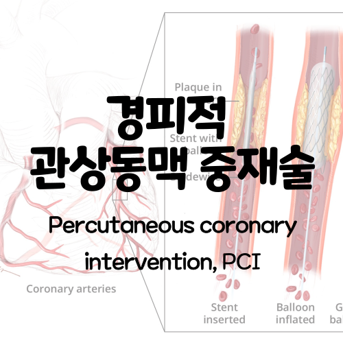 경피적 관상동맥 중재술 Percutaneous coronary artery intervention (PCI, PTCA, CAG ...