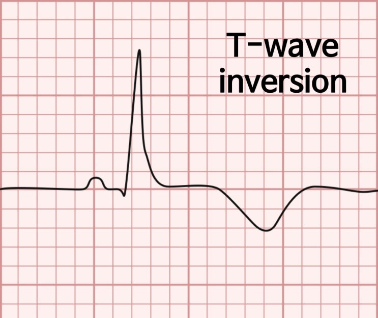 T-wave inversion (T-파 역전) EKG에 대한 임상적의의에 대해서 알아봐요 : 네이버 블로그