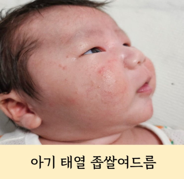 신생아 얼굴 수딩젤 아기 태열 좁쌀 여드름 관리하는중 네이버 블로그