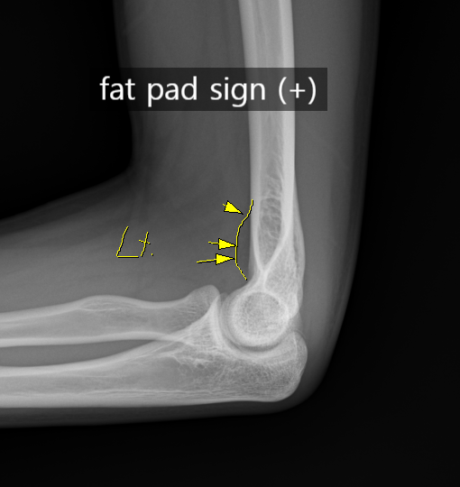 팻패드사인(fat pad sign)이 중요한 이유 _ 팔꿈치 잠행골절 진단 : 네이버 블로그