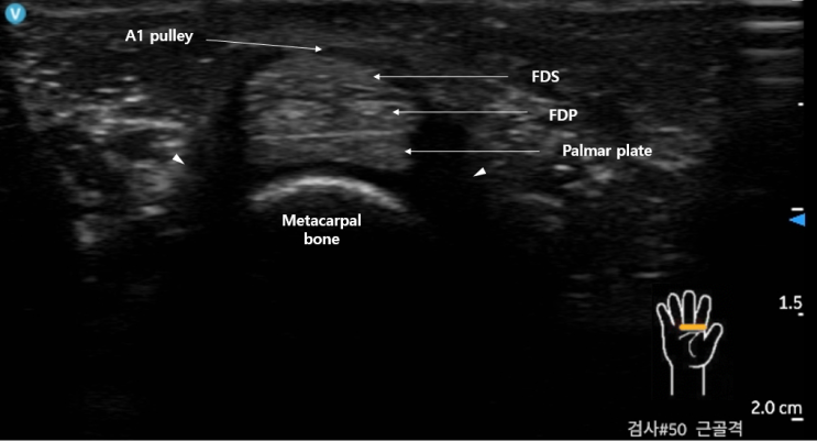 [손가락 초음파] 1. Annular ligament (Pulley, 활차) : 네이버 블로그
