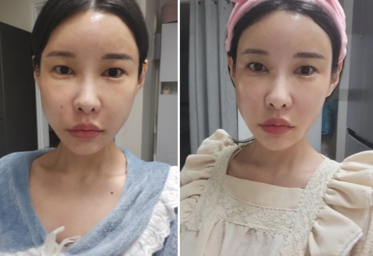 내돈내산 강남 스킨부스터 수면마취 피부재생에 좋은 리쥬란힐러 4cc랑 광채나는 샤넬주사3cc 찐 리얼후기 네이버 블로그