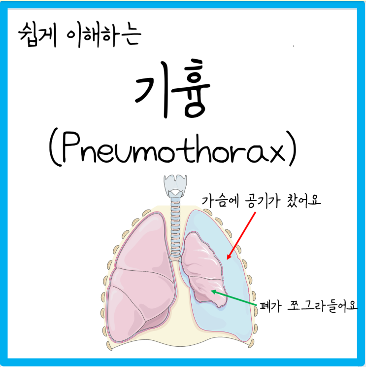 기흉 Pneumothorax 쉽게 이해하기 기흉의 정의 원인 검사 치료 네이버 블로그