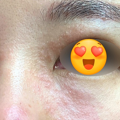 동국제약 마데카크림 피부 부작용 알레르기 후기 홍조 오돌토돌 두드러기 가려움증 네이버 블로그